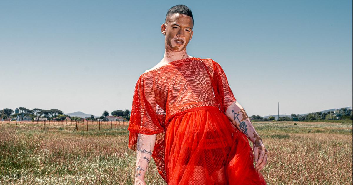 After being shunned, this model with vitiligo is finally owning his ...